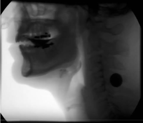 Swallowing (Dysphagia) - Northwestern University Center for Audiology ...